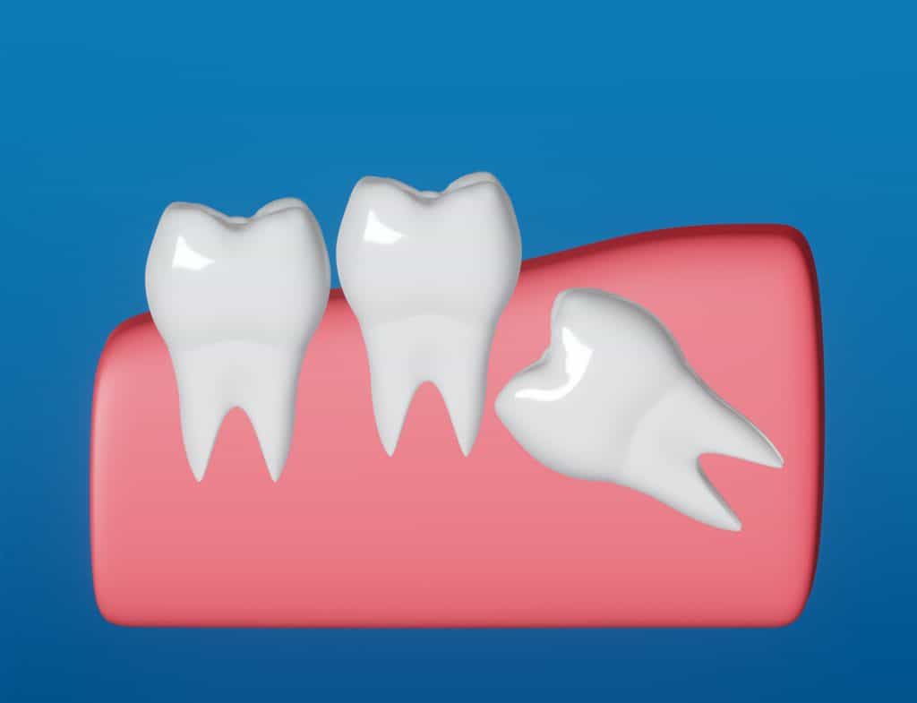 What Happens if Wisdom Teeth Aren’t Removed? | Pearl Dental Care