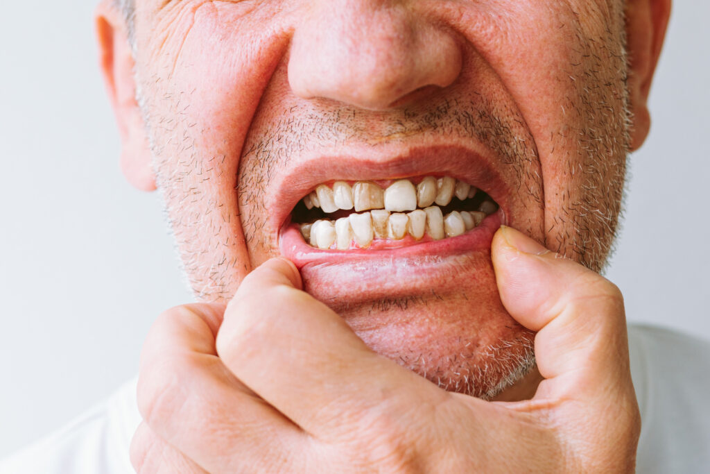What Causes Tooth Decay? | Pearl Dental Care